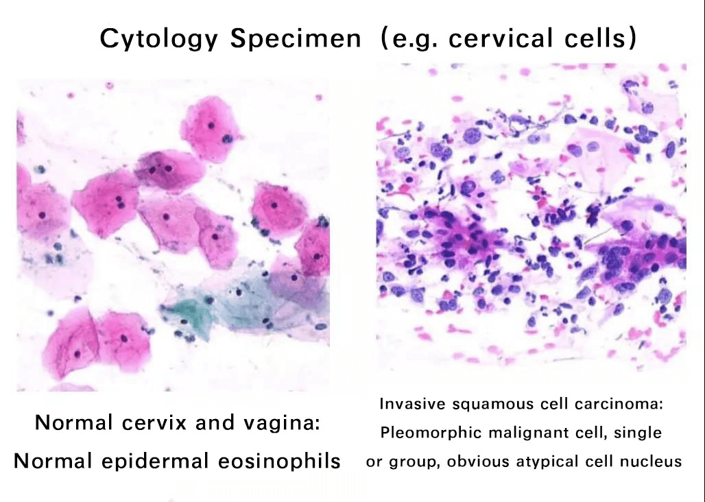In Shape Of Normal Cervix Cell Under Microscope
